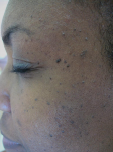 The most common skin lesions (benign) | With Pictures