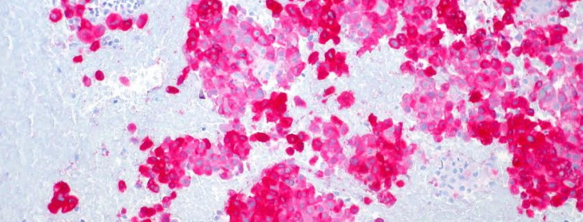 Metastatic Melanoma: What is it?