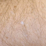 Skin Cancer | Complete Overview of Symptoms & Types