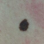 Melanoma pictures | Example pictures of melanoma symptoms